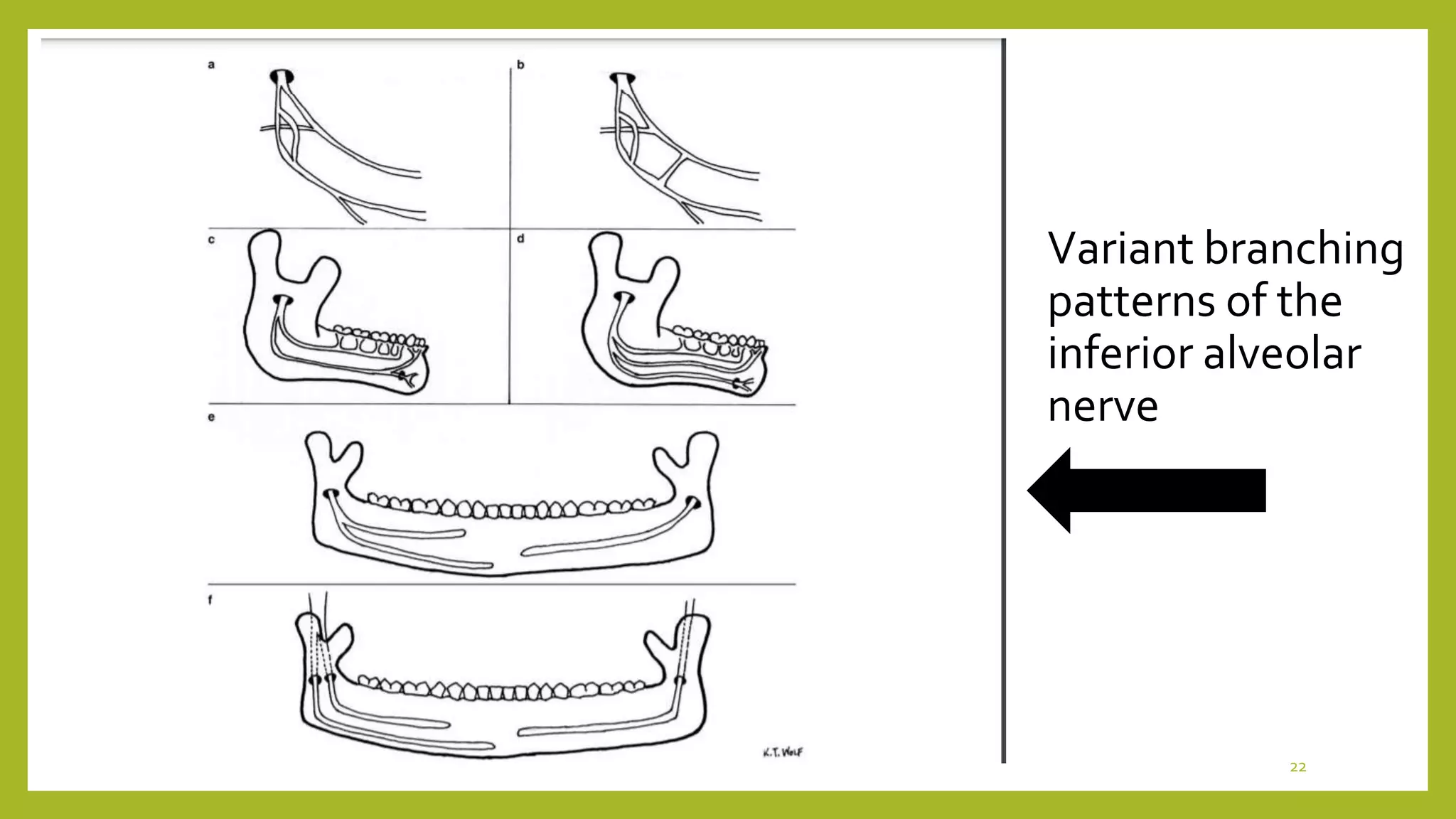 Inferior alveolar nerve | PPTX
