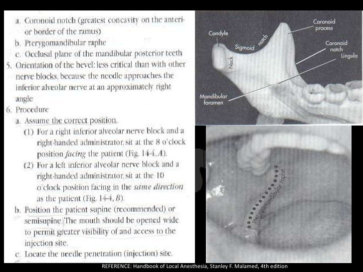 Inferior Alveolar Nerve Block Anesthesia