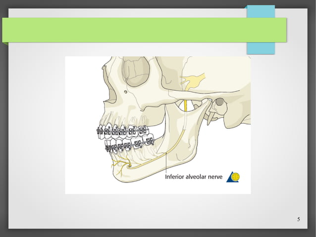 Inferior alveolar nerve block | ODP | Dental Health | Diseases and ...
