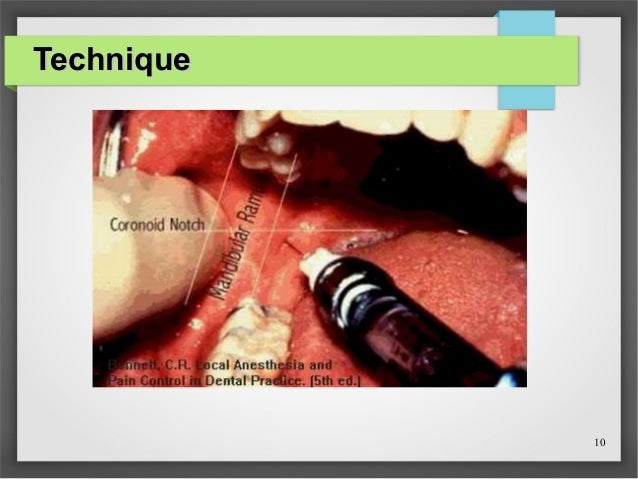 Inferior alveolar nerve block