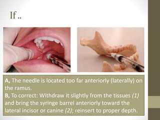 Mandibular Anesthesia : Inferior alveolar nerve block | PPTX