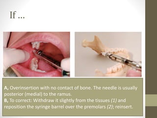 Mandibular Anesthesia : Inferior alveolar nerve block | PPTX