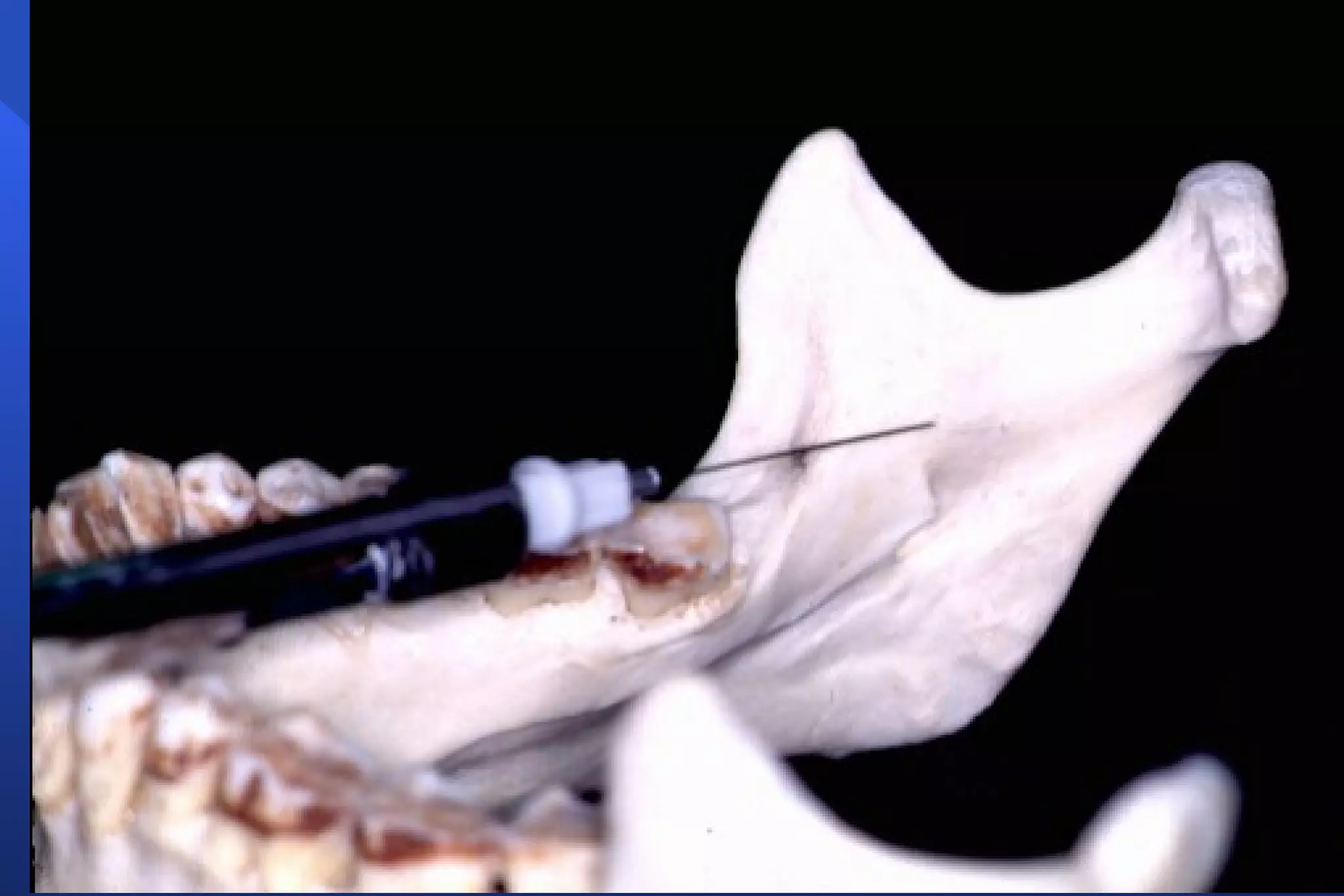 Inferior Alveolar Nerve Block | PPT