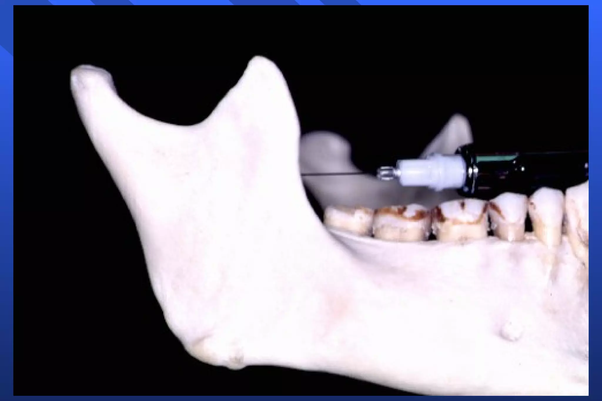 Inferior Alveolar Nerve Block | PPT