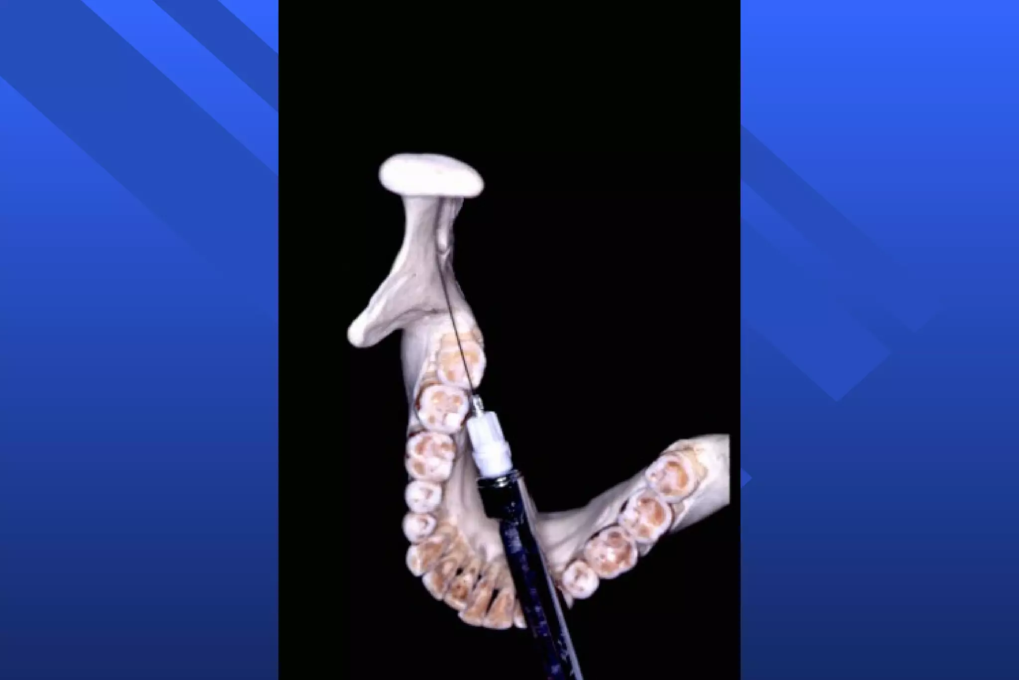 Inferior Alveolar Nerve Block | PPT