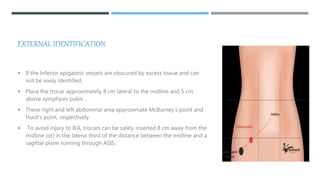 Inferior epigastric vessels injury; What to do ? | PPTX
