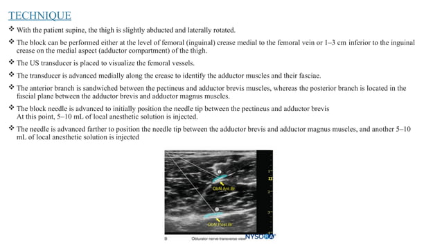 INFERIOR LIMB NERVE BLOCKS ultrasound guided.pptx