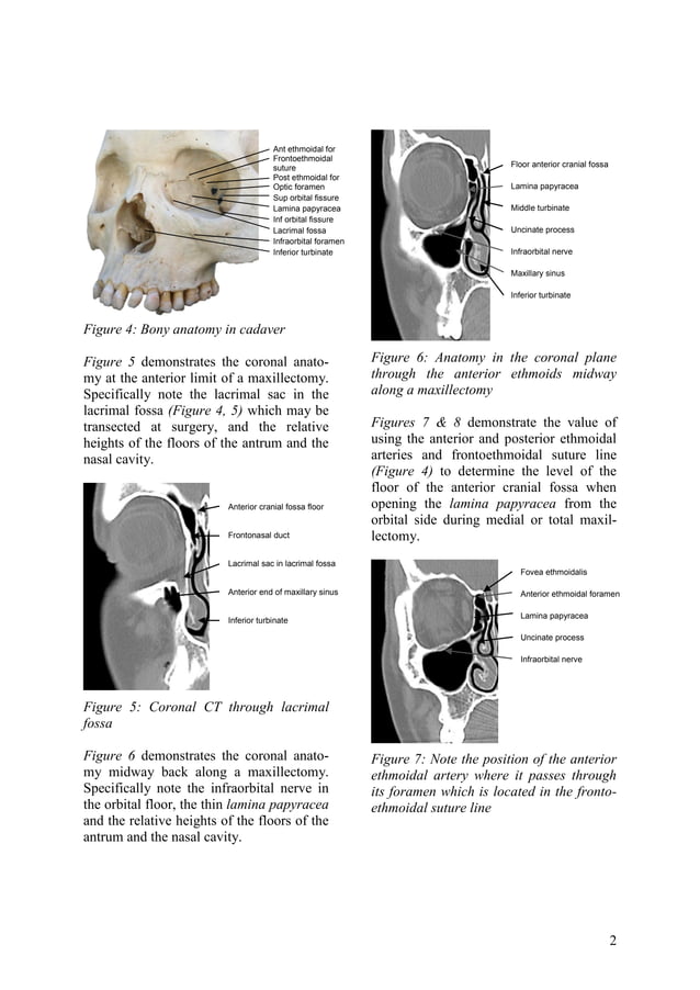 Inferior Maxillectomy oh head and neck surgery | PDF