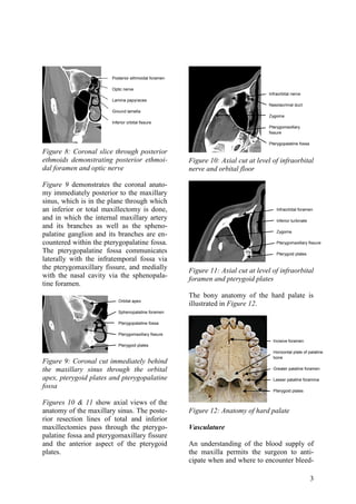 Inferior Maxillectomy oh head and neck surgery | PDF