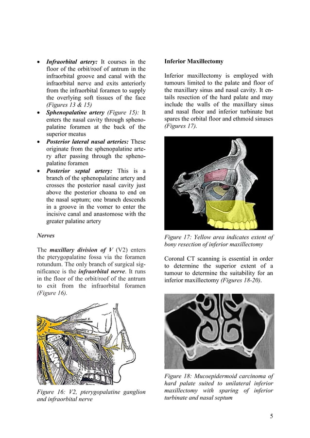 Inferior Maxillectomy oh head and neck surgery | PDF