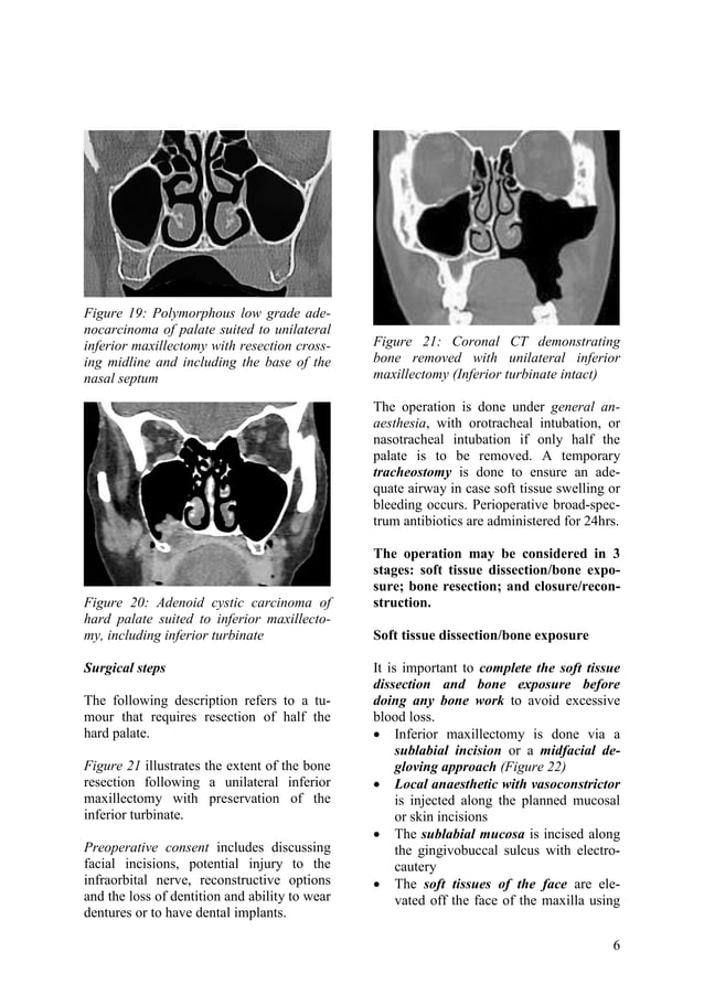 Inferior Maxillectomy oh head and neck surgery | PDF