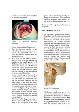 Inferior Maxillectomy oh head and neck surgery | PDF