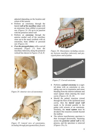 Inferior Maxillectomy oh head and neck surgery | PDF
