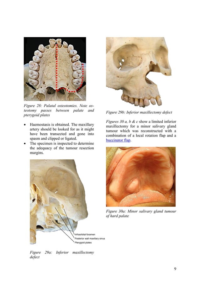 Inferior Maxillectomy oh head and neck surgery | PDF