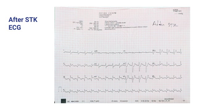 Inferior MI with posterior extension - by. Dr. Md. Maksud Islam Shamim ...
