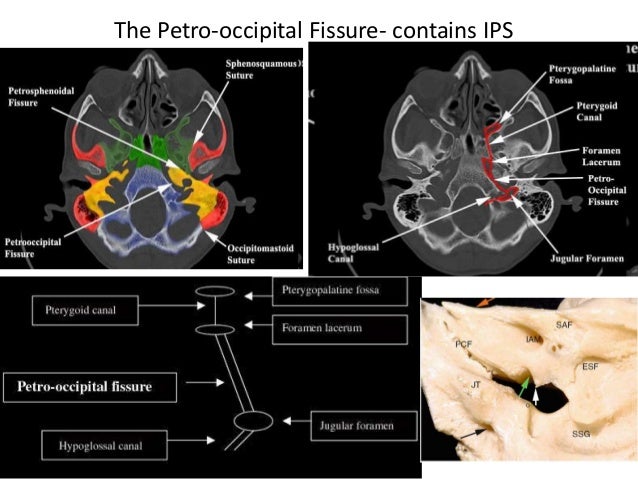 Inferior petrosal sinus 360°