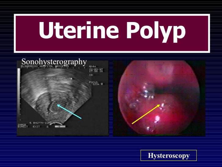 Dc Hysteroscopy Procedure