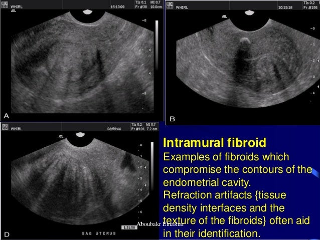 Management of infertility