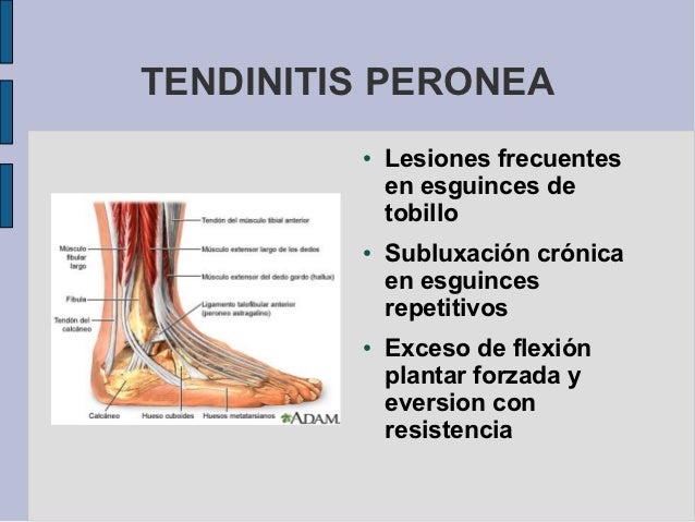 Tendinitis en el pie - Imagui