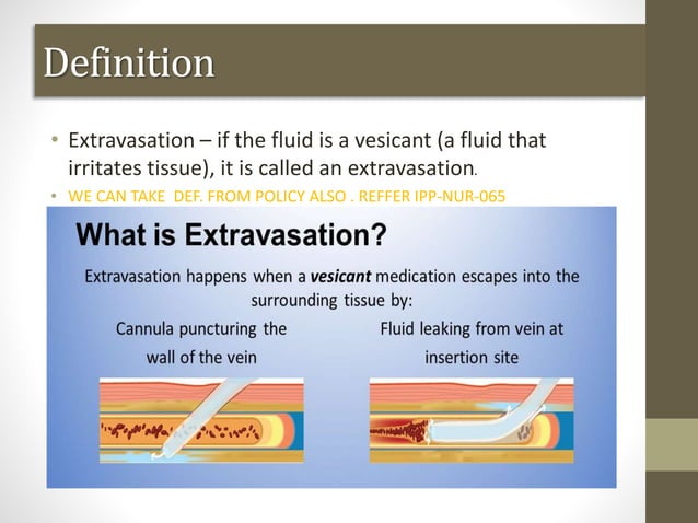 infiltration and extravasation.pptx