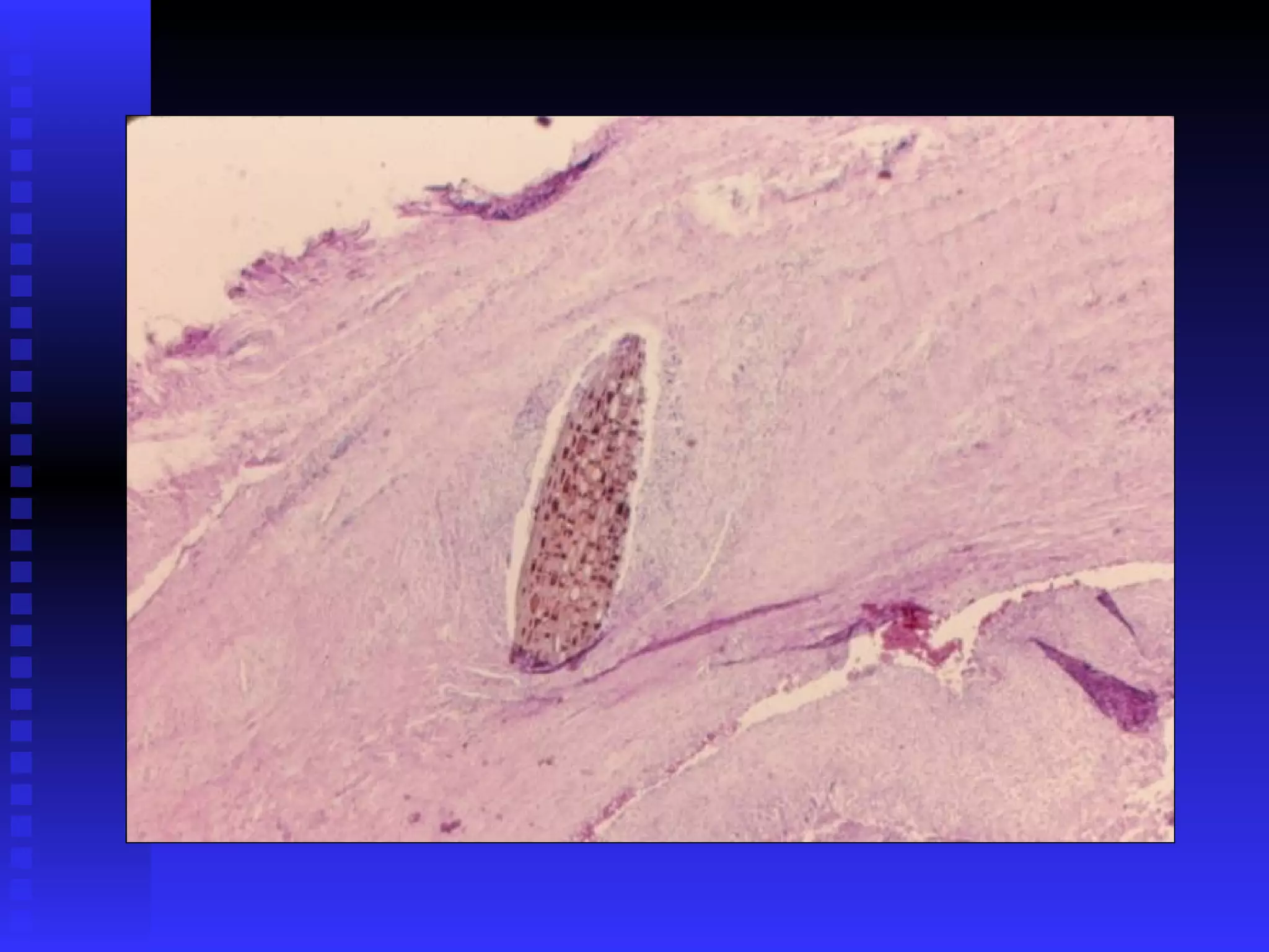 Inflamacion cronica | PPT