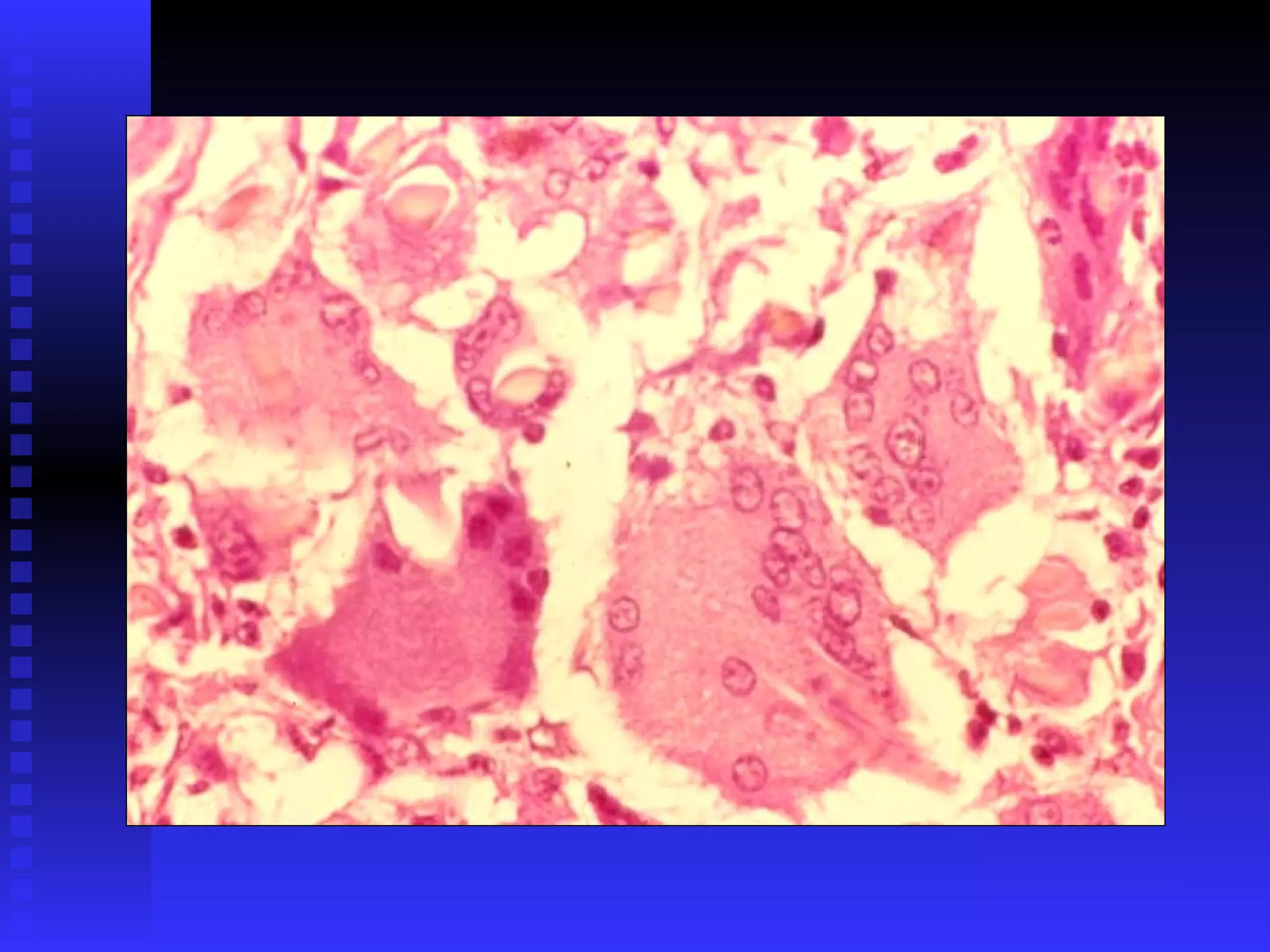 Inflamacion cronica | PPT