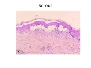 Inflammation | PPTX