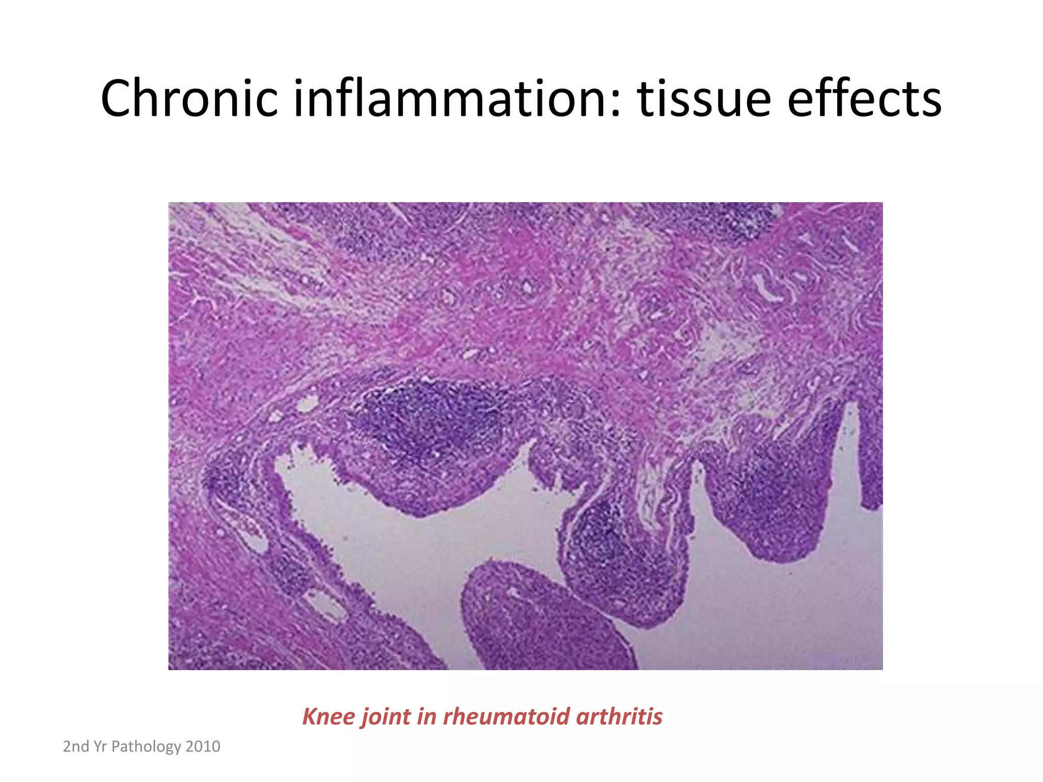 Inflammation | PPT