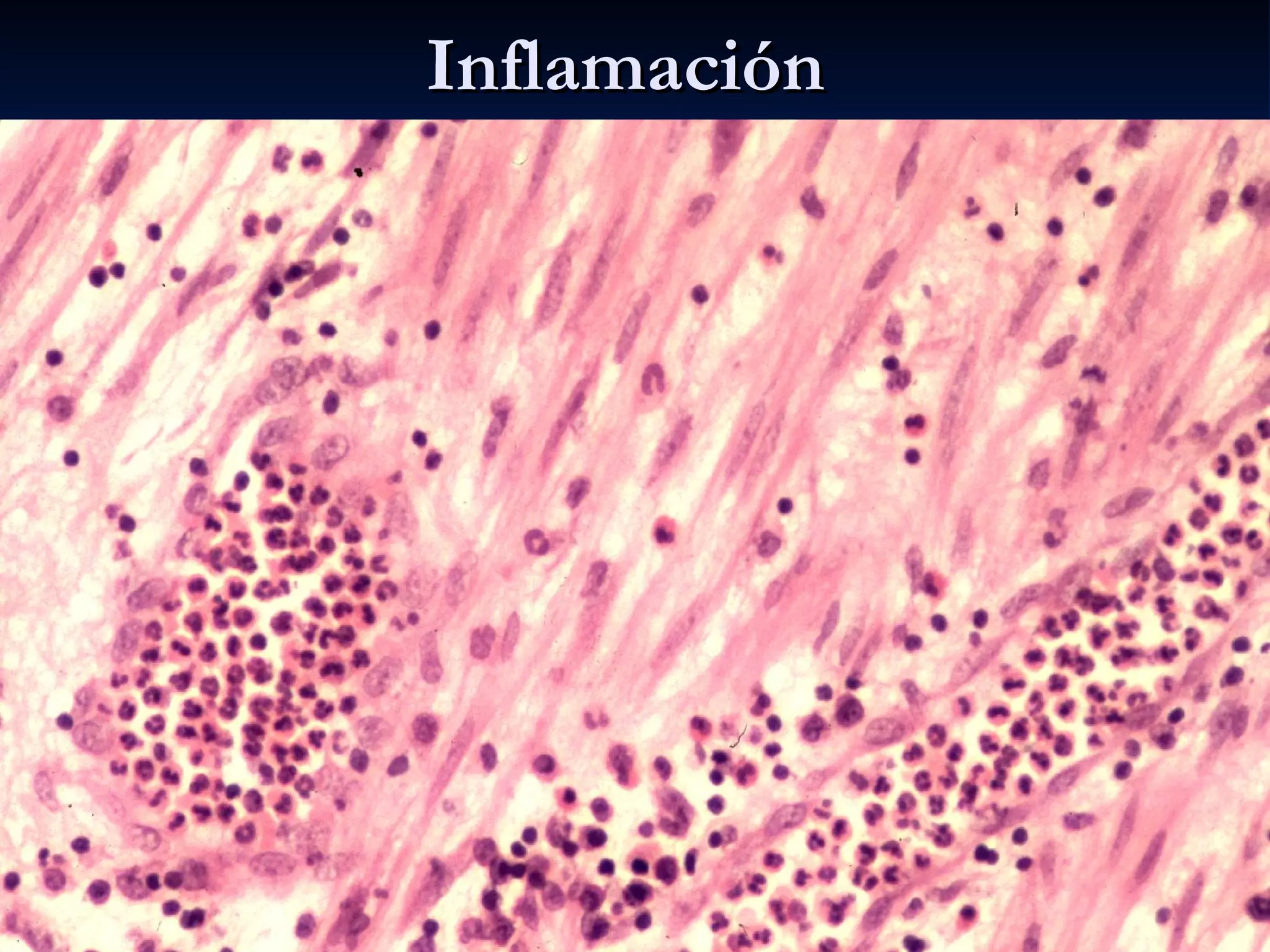 InflamacióN | PPT
