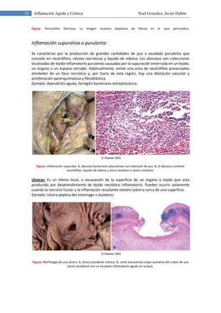 Inflamación aguda y crónica | DOCX
