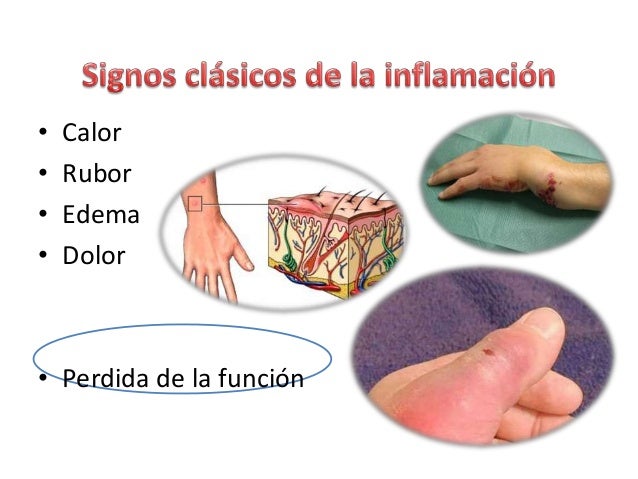 Inflamacion