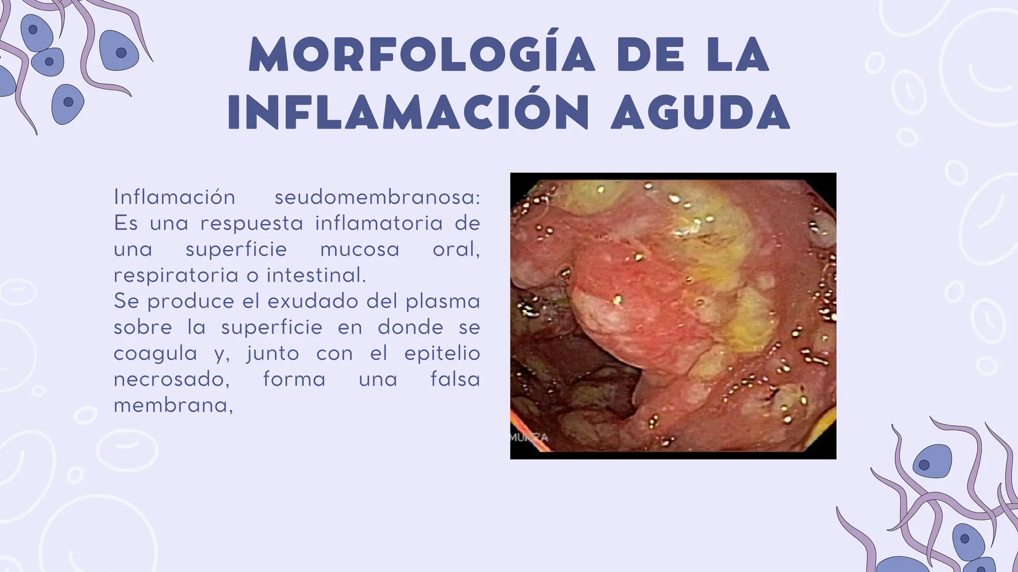 Inflamación y generalidades anatomía patológica | PDF