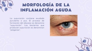 Inflamación y generalidades anatomía patológica | PDF