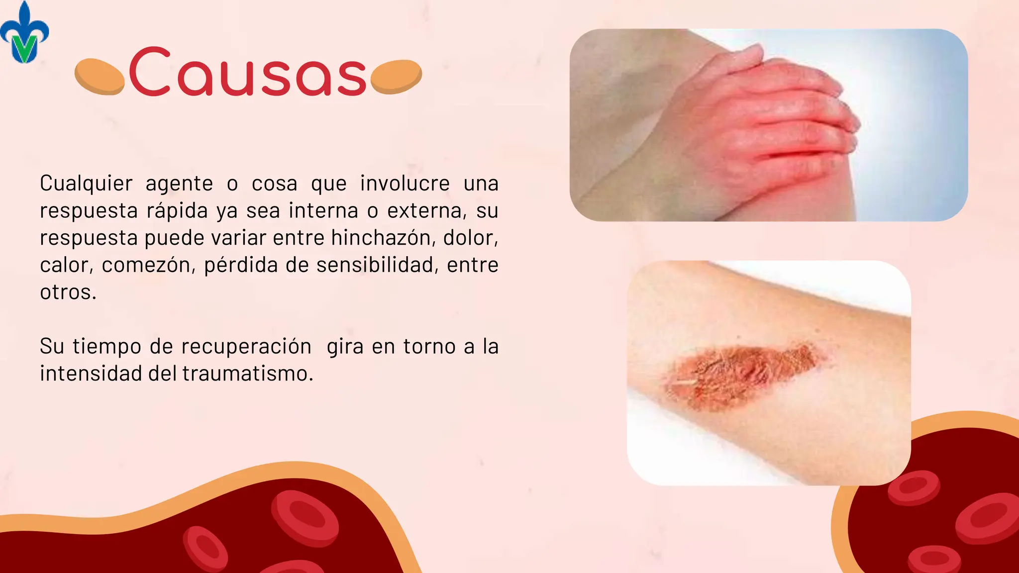 Inflamacion aguda - patologia general medicina | PPTX