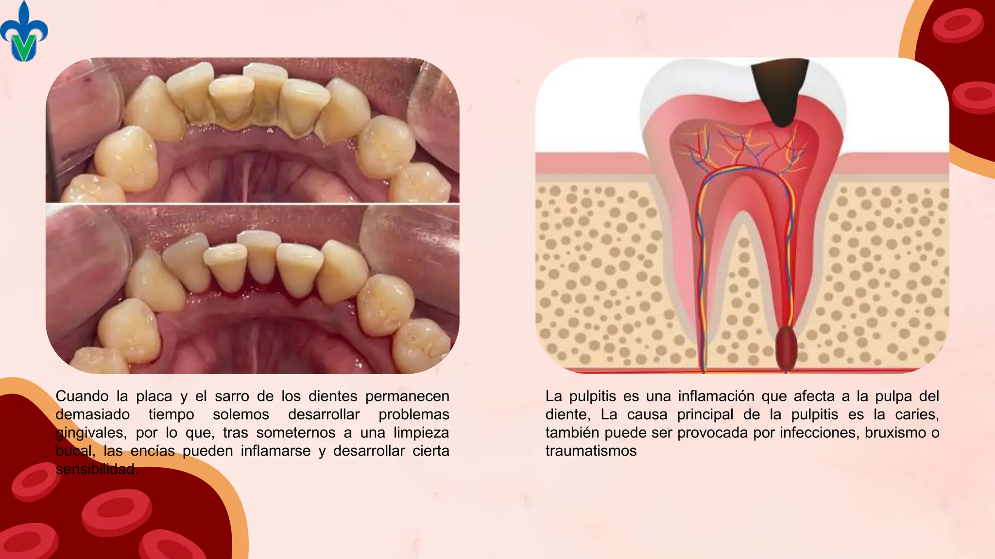 Inflamacion aguda - patologia general medicina | PPTX