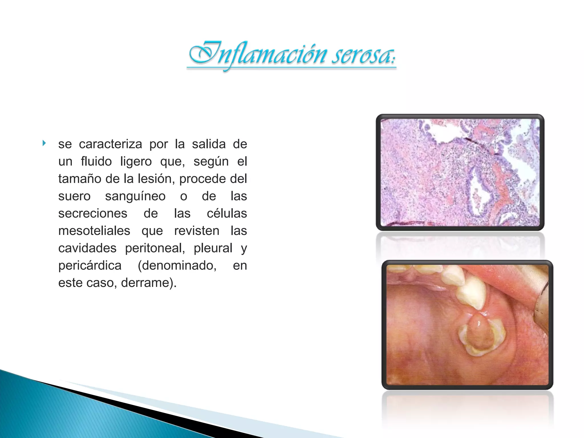 Inflamacion aguda y cronica | PPT | Medical Health