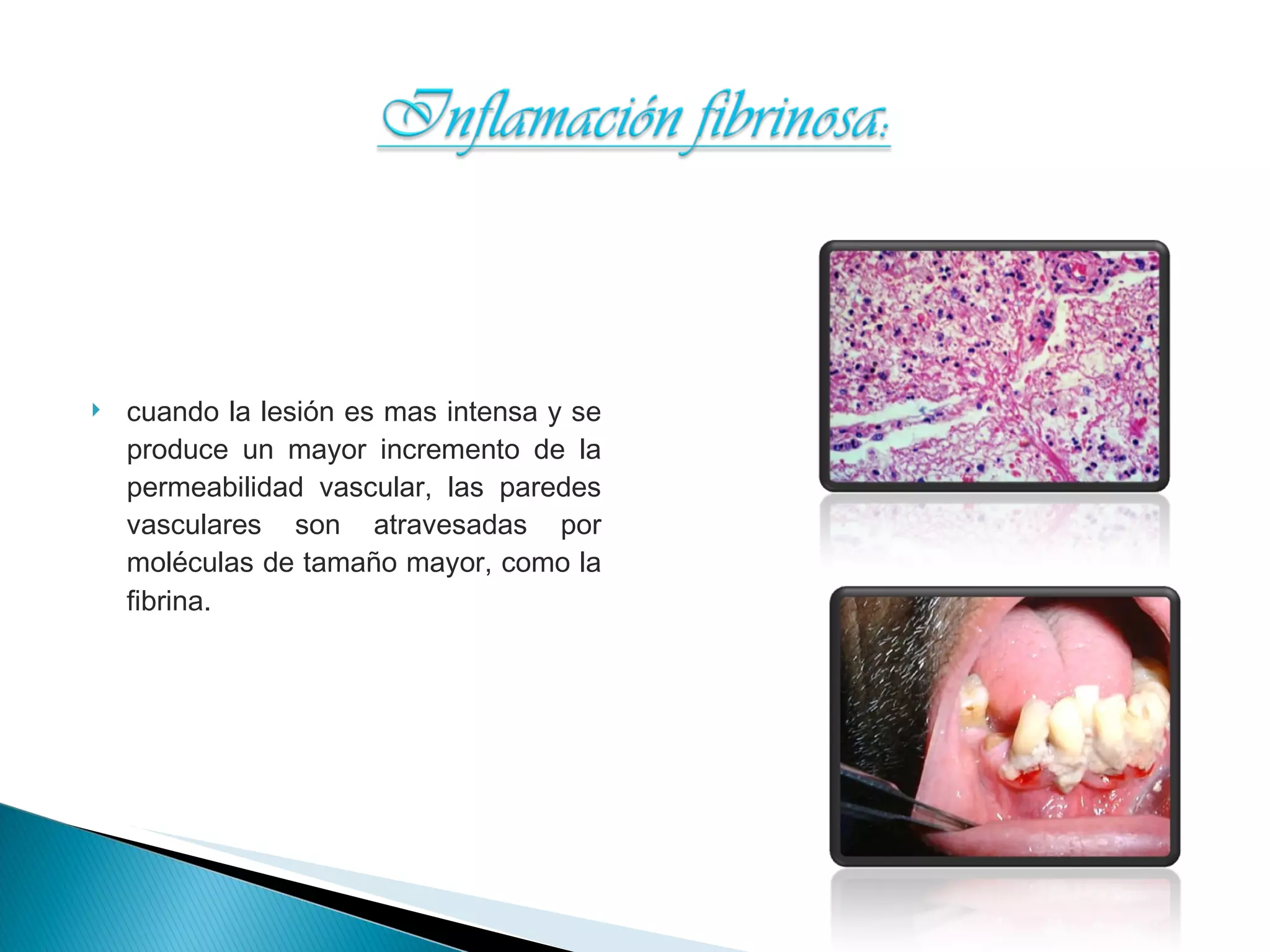 Inflamacion aguda y cronica | PPT | Medical Health