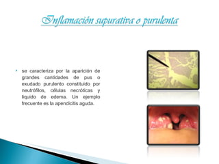 Inflamacion aguda y cronica | PPT