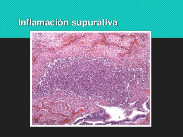 Inflamación aguda e inflamación crónica