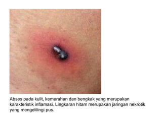 inflamasi-120125211417-phpakkkkkkkkkkkkkkpp02.pptx