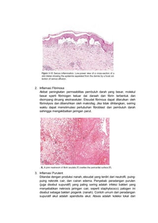 Inflamasi farin | DOCX