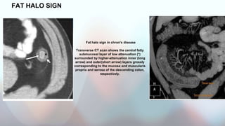 INFLAMATORY BOWL DISEASE orals.pptx