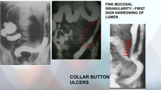 INFLAMATORY BOWL DISEASE orals.pptx