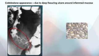 INFLAMATORY BOWL DISEASE orals.pptx