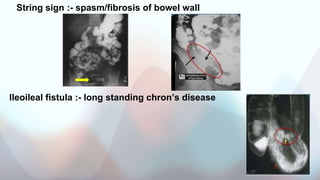 INFLAMATORY BOWL DISEASE orals.pptx