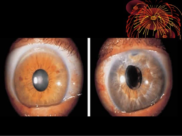 Inflammatory Glaucoma