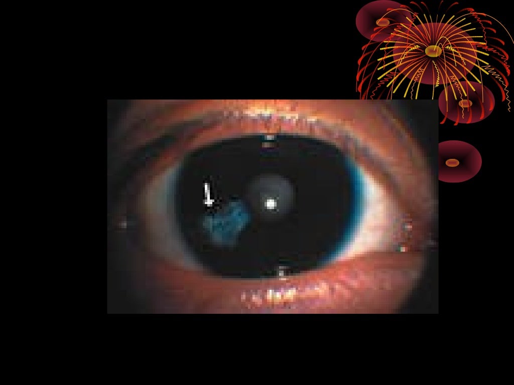 Inflammatory Glaucoma Glaucoma Explained, And Why Regular Eye Checks