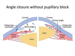 Inflamatory glaucoma | PPT