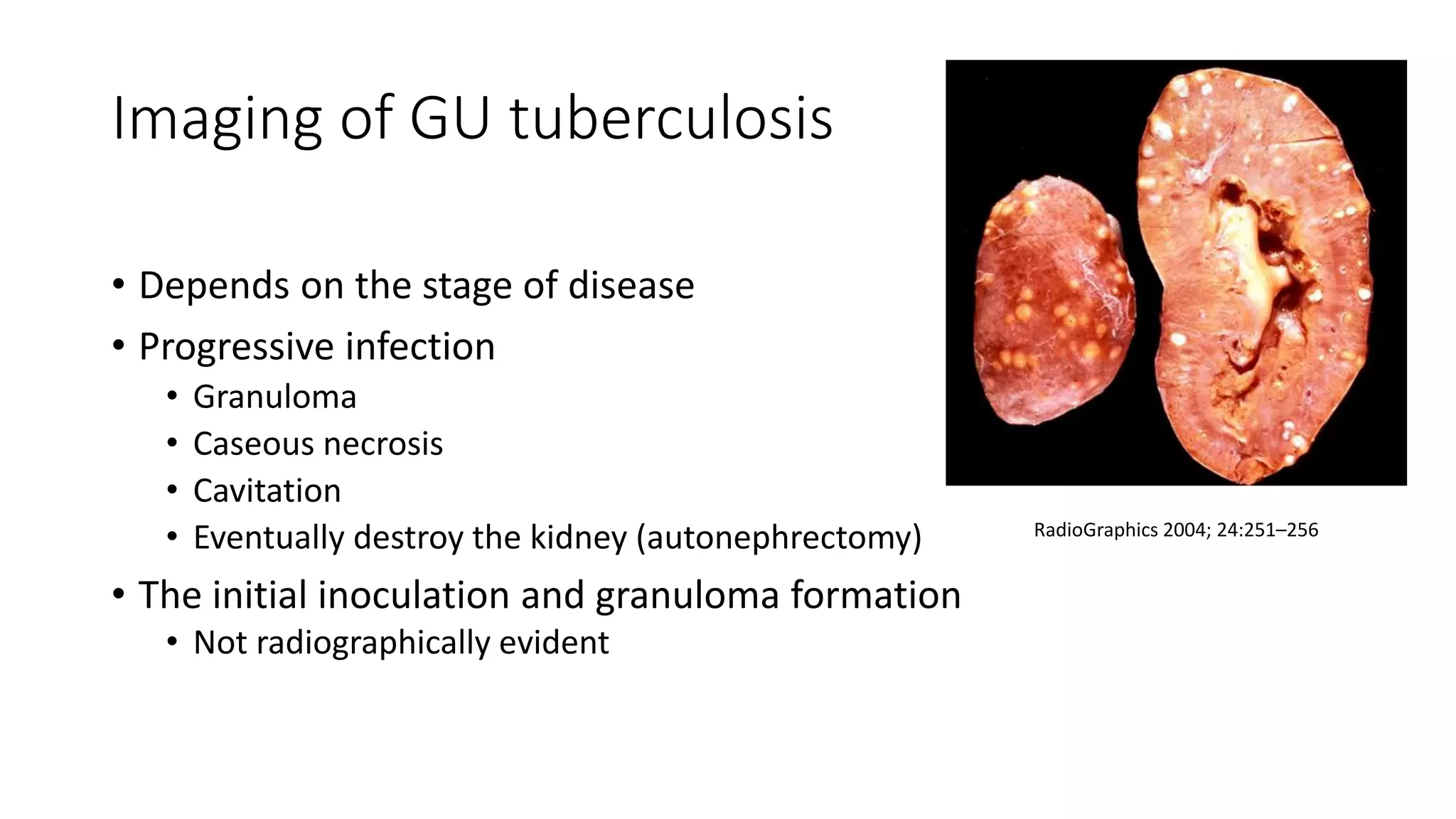 Inflammatory diseases of the kidney Part 2 | PDF