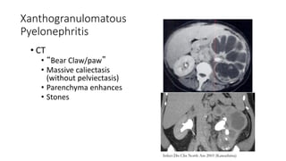 Inflammatory diseases of the kidney Part 2 | PDF
